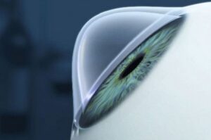 Ceratocone – COLL – Clinica de Olhos DR. Luiz Lani